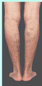 Venous Disease Progression | Varicose Vein Removal Melbourne